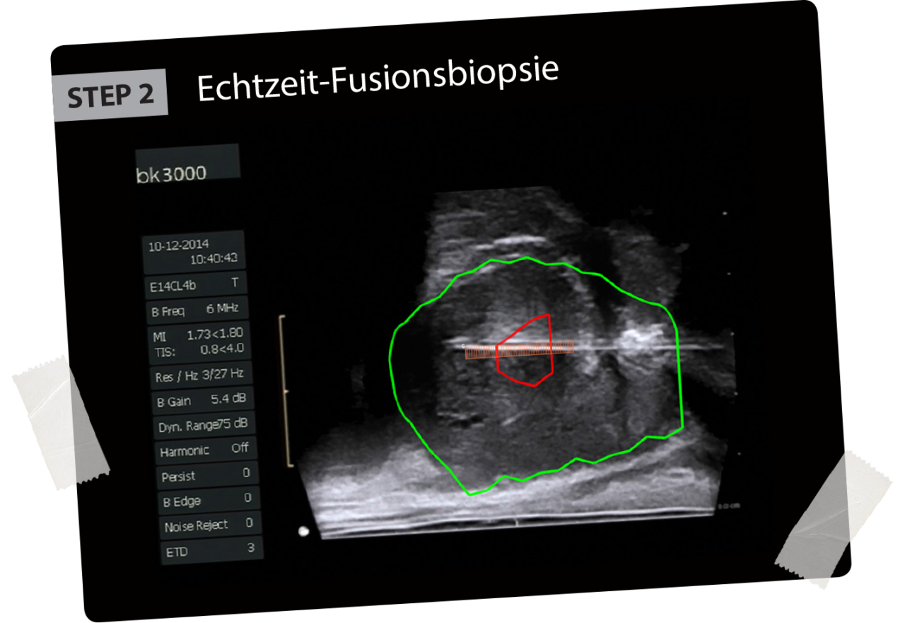 BioJet MRI-Fusionbiopsies | MTT